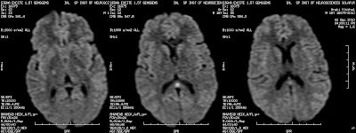 Dr Balaji Anvekar FRCR: Restricted diffusion in Splenium of Corpus Callosum
