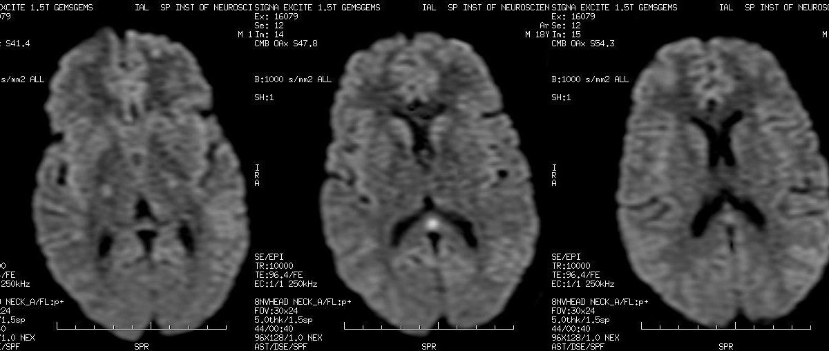 Neuroradiology Cases: Restricted diffusion in Splenium of Corpus Callosum