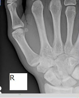 Bifid Thumb-Plain Film - Sumer's Radiology Blog