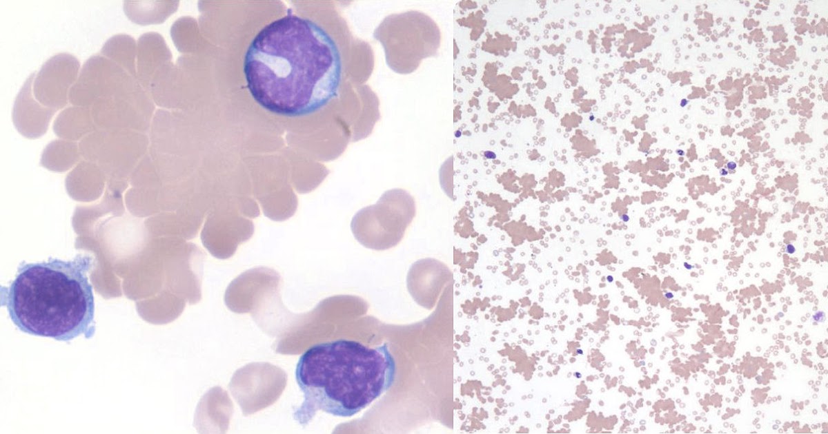 Medical Laboratory and Biomedical Science: Red cell agglutination in ...