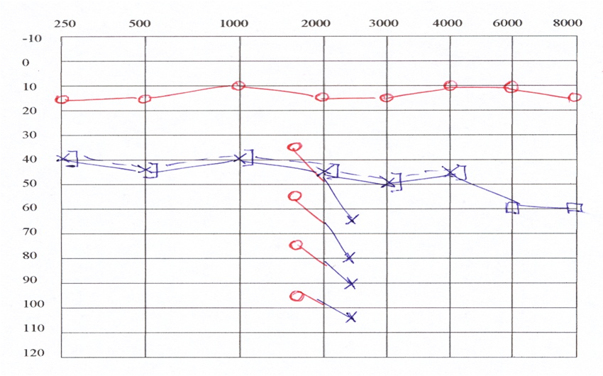 Pruebas Especiales Supraliminares para la Detección de Reclutamiento ...