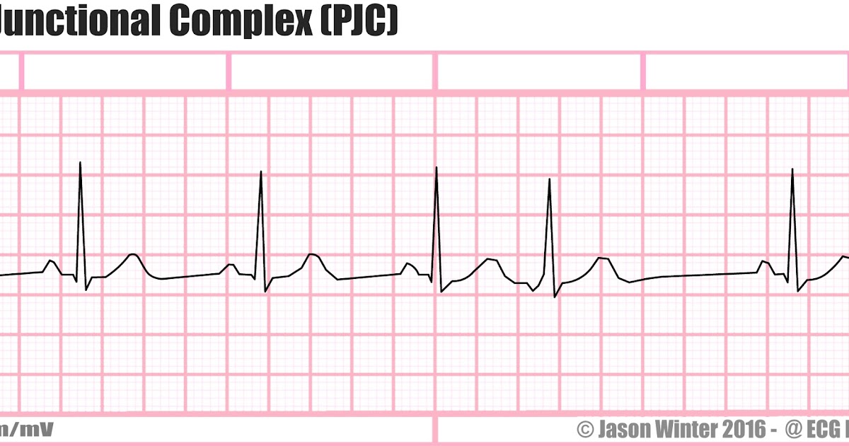 ECG Educator Blog : Premature Junctional Complex (PJC)