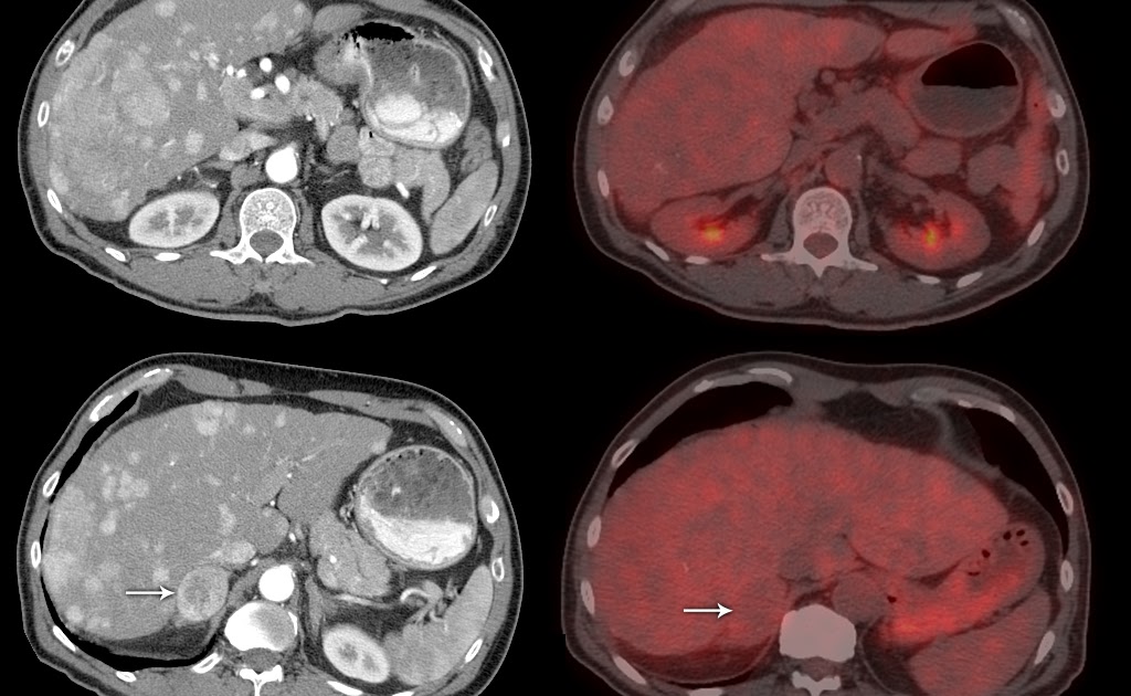 Roentgen Ray Reader: F18-FDG PET and Hepatocellular Carcinoma