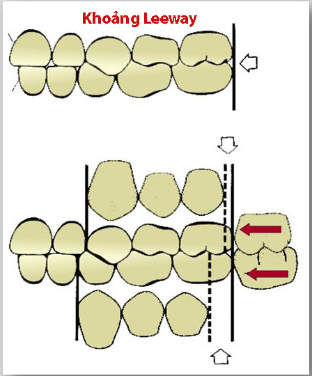 CHỈNH RĂNG COPA: Khoảng leeway
