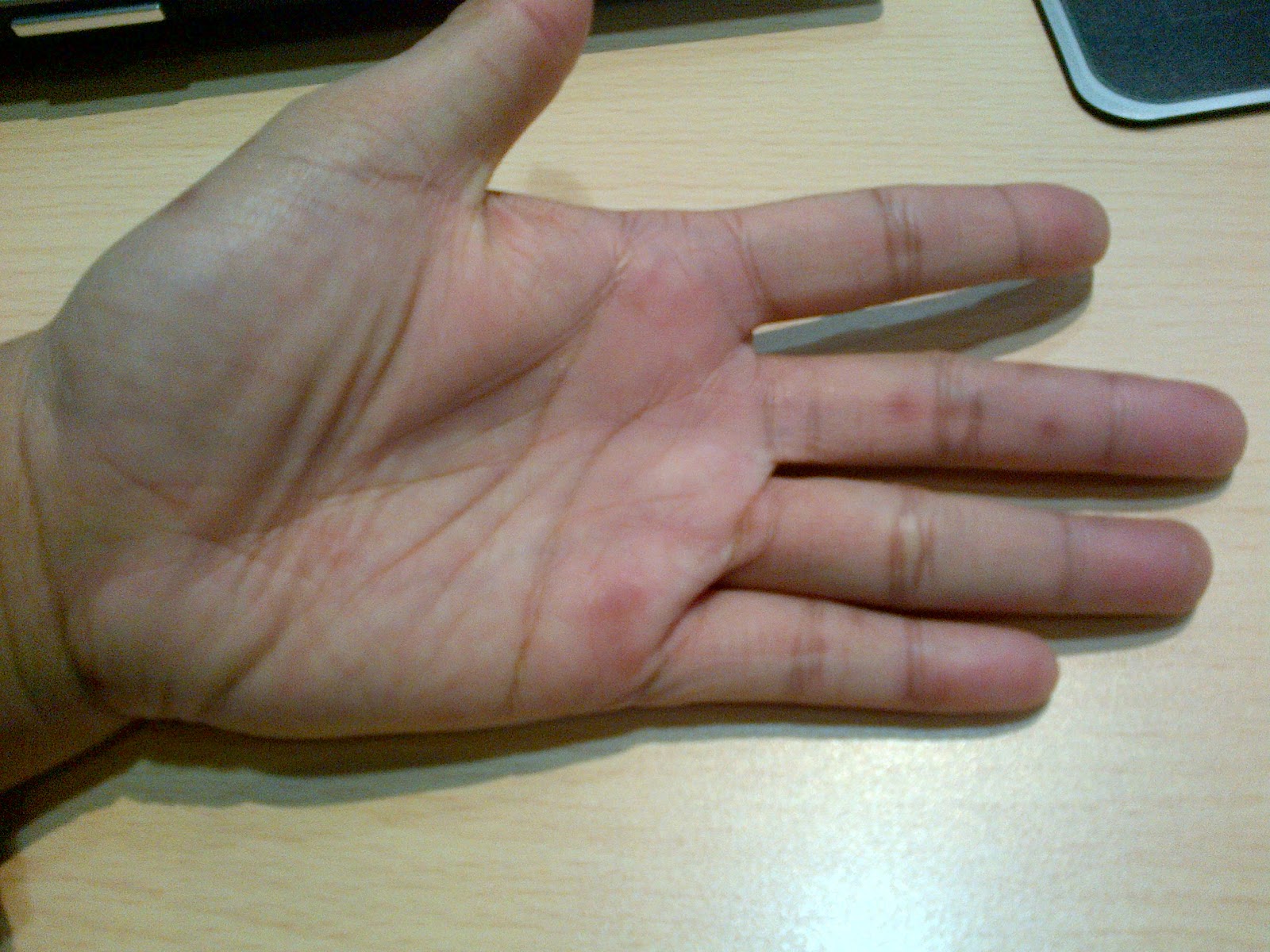 Let's talk about Health & Beauty: Hand, foot and mouth disease (HFMD ...