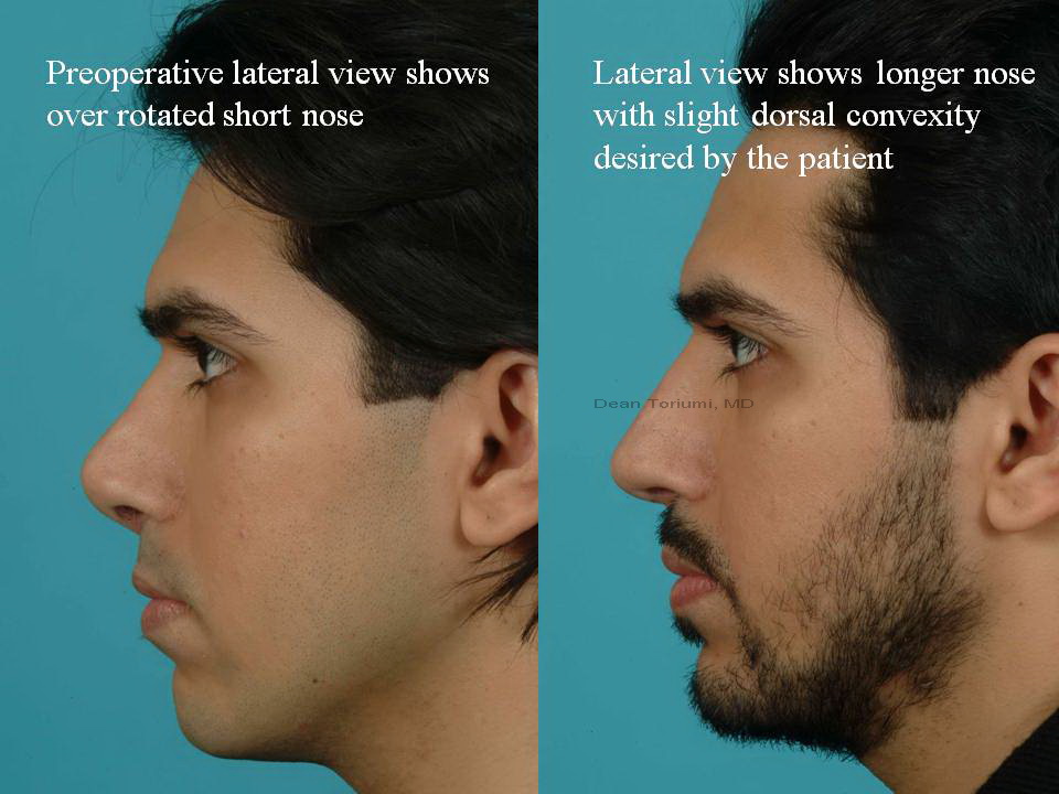 Dr. Dean Toriumi Reviews: Dean Toriumi Reviews: Nasal length restored ...