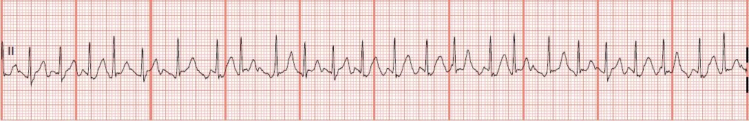 New Onset Atrial Fibrillation Part 2