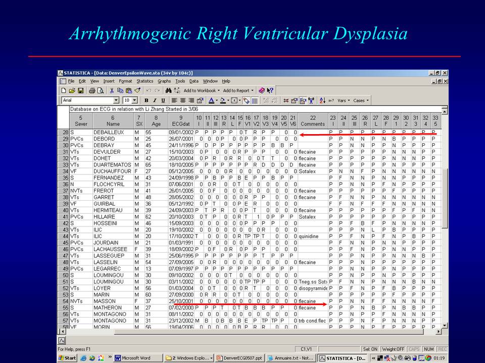 ARVCsGF: Advances in ARVD ECG interpretation