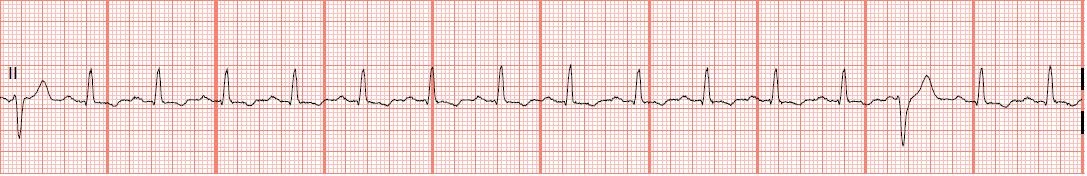 EKG Rhythm Strip Quiz 88