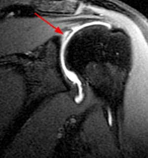 MRI Musculo-Skeletal Section: Labrum