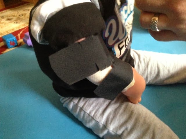 Hope for Arthrogryposis