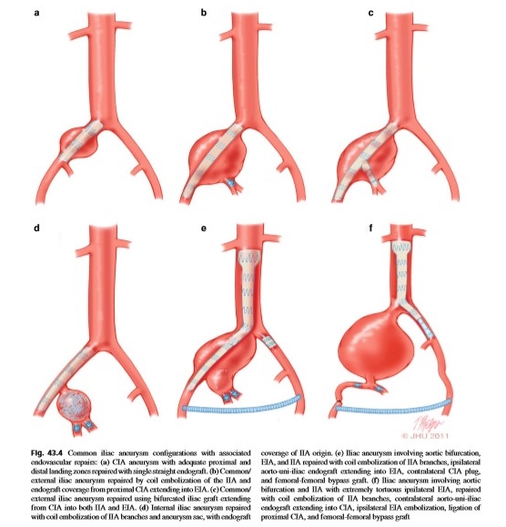 Vascular Mind : ILIAC ARTERY ANEURYSM. ENDOVASCULAR OPTIONS.