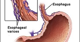 Ayurvedic Treatment for Esophageal Varices - Symptoms, Diagnosis ...