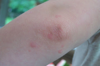 Beyond the Mirror: What Cold Induced Urticaria Looks Like