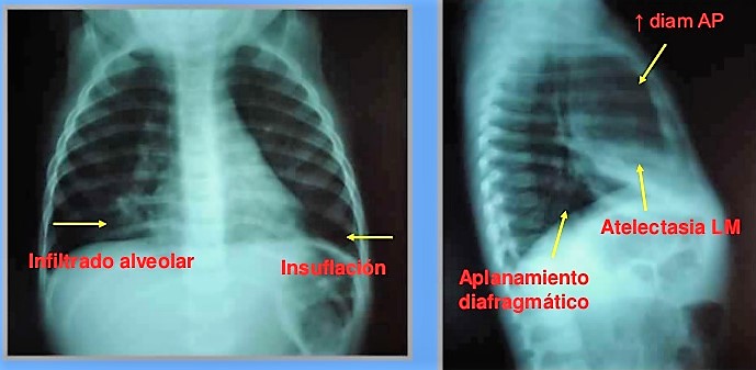 sindrome sibilante bronquiolitis