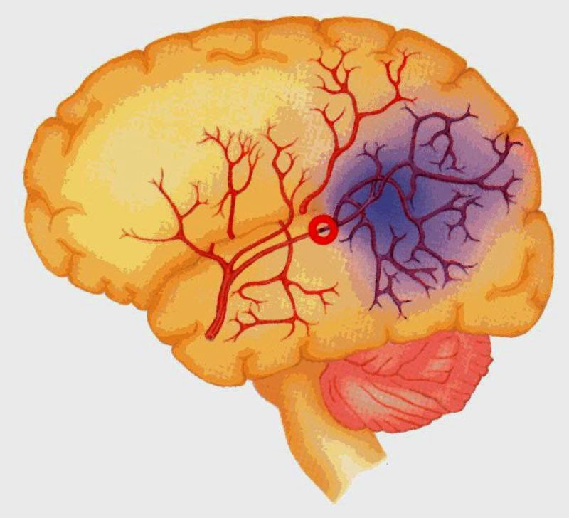 ICTUS: septiembre 2015