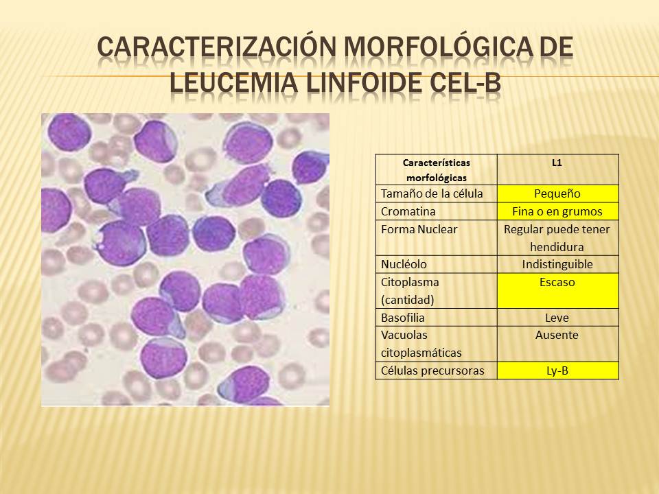 Leucemia Linfoide