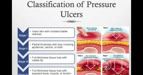PRESSURE SORES - DNB Orthopaedics MS Orthopedics MRCS Exam GUIDE ...