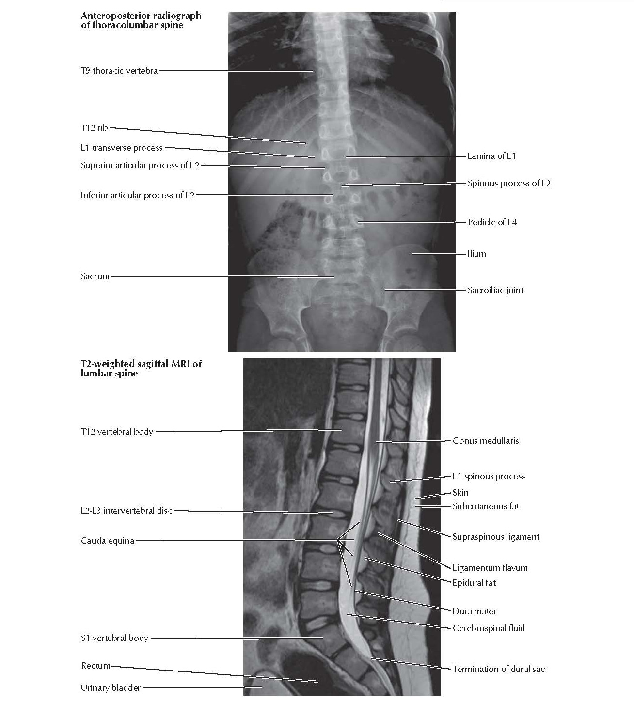 Vertebrae: Radiograph and MRI Anatomy - pediagenosis