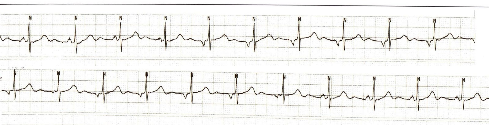 Wandering Atrial Pacemaker