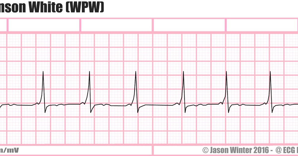 ECG Educator Blog : Wolff-Parkinson-White