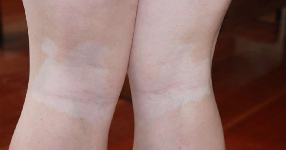 VİTİLİGO (ALA) HASTALIĞI BİTKİSEL TEDAVİSİ