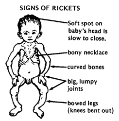 Homoeopathy for Kids: HOMOEOPATHY FOR RICKETS IN KIDS