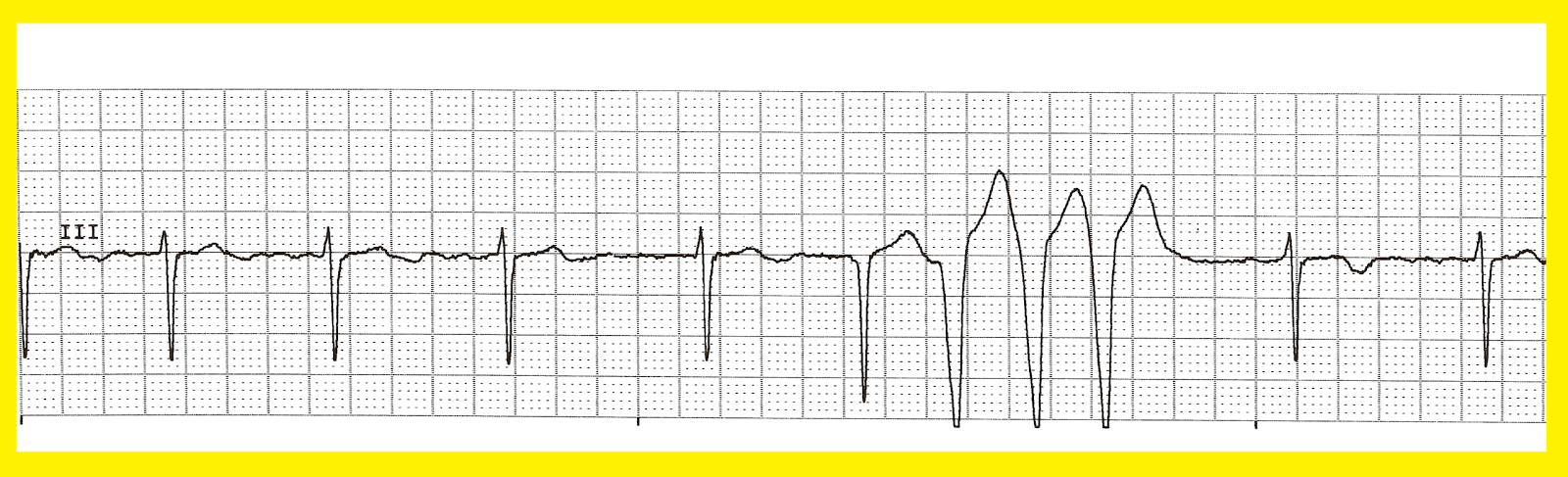 Practice EKG Strips 325