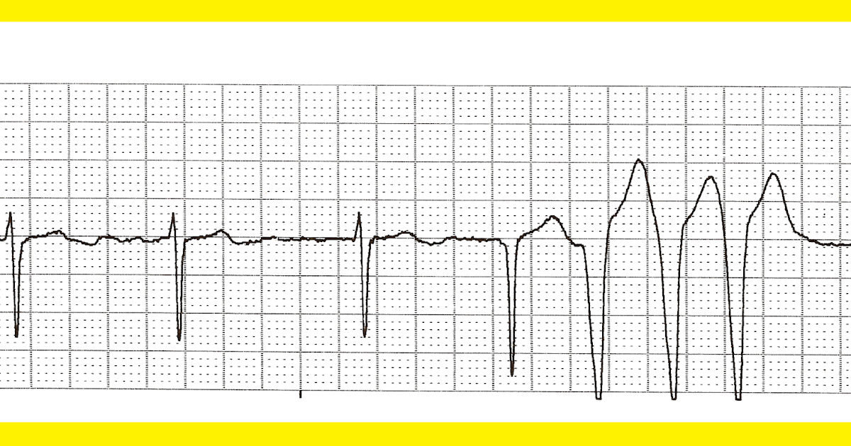 Float Nurse: Practice EKG Strips 325