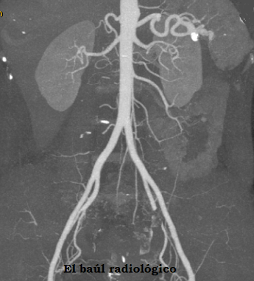 El Baúl Radiológico: CONTRASTE YODADO EN TOMOGRAFÍA COMPUTARIZADA ...