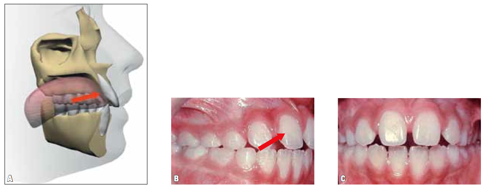 Orthodontic Corner: Anterior open bite and tongue positions, DPJO