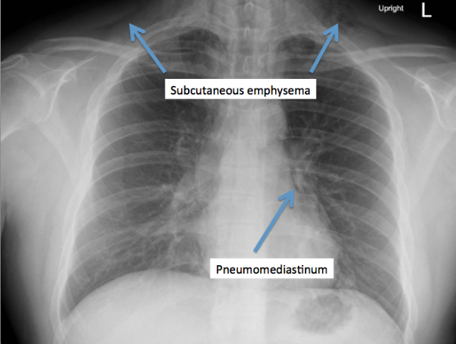 Emergency Medicine Visual Diagnosis: Diagnosis: Spontaneous ...