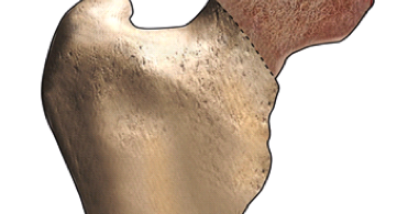 Necroza aseptica de cap femural (vestita NACF)