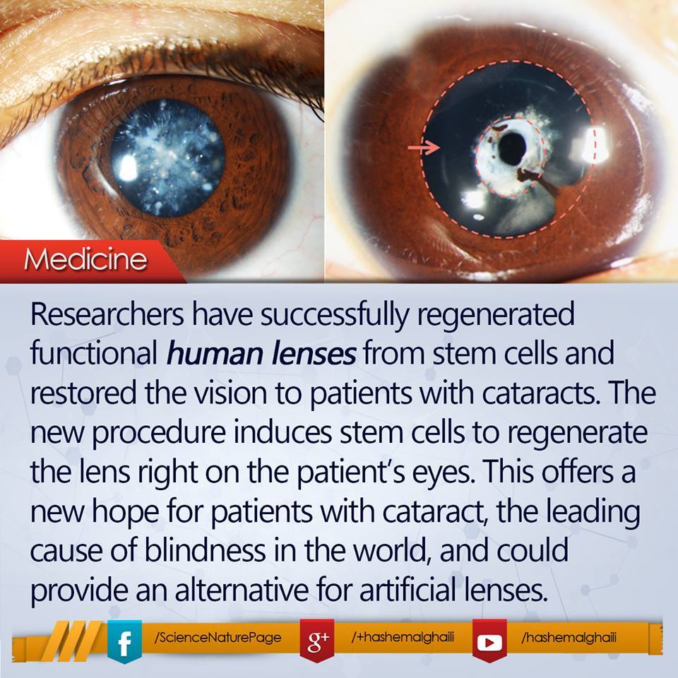 Human lens successfully regenerated using stem cells