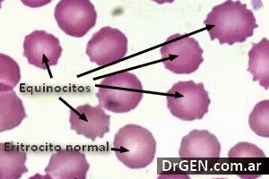 Fichero de Hematología Heber Mayén: Anormalidades morfológicas de los ...