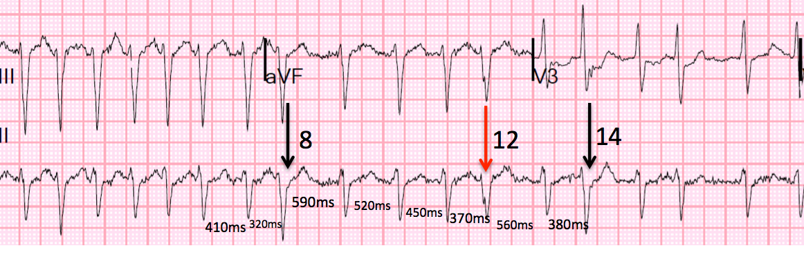 Dr. Smith's ECG Blog: Atrial Fib and RVR with a run of wide complex ...