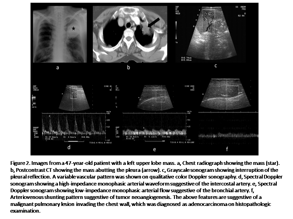 BÀI SOẠN VỀ SIÊU ÂM CHẨN ĐOÁN: CHEST WALL INVASION by LUNG TUMORS: US ...