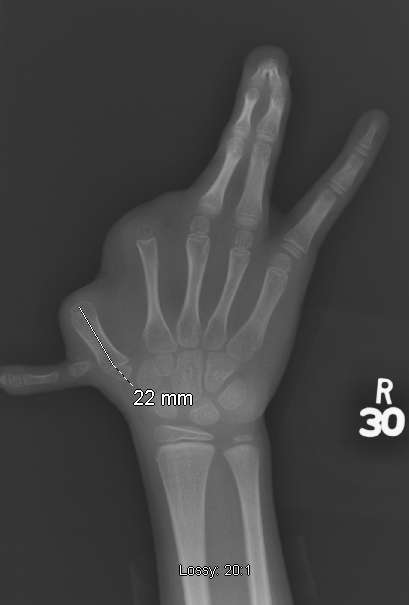 Finger Lengthening | Congenital Hand and Arm Differences | Washington ...