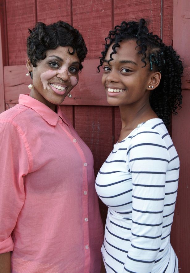 Photo: Woman with rare skin condition says men find it irresistible