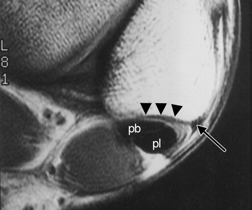MRI Musculo-Skeletal Section: Peroneal tendon lesions.
