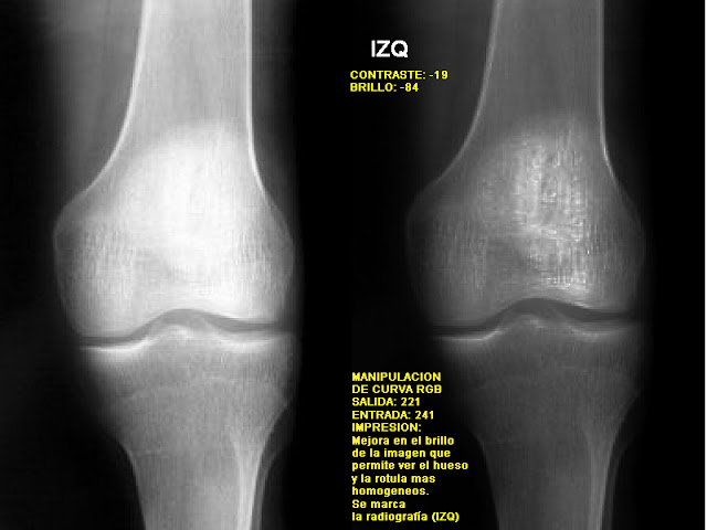 RadioLuz: Radiografía rodilla normal