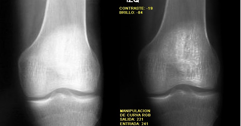 RadioLuz: Radiografía rodilla normal
