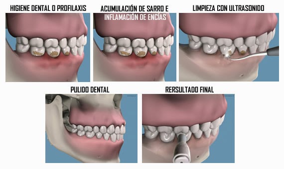 Como se lleva a cabo una profilaxis