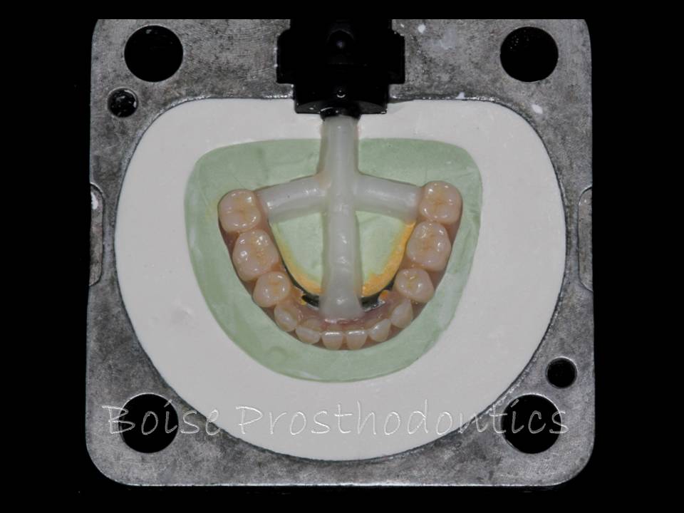 Boise Idaho Prosthodontics: Picture Sequence of Maxillary Complete ...