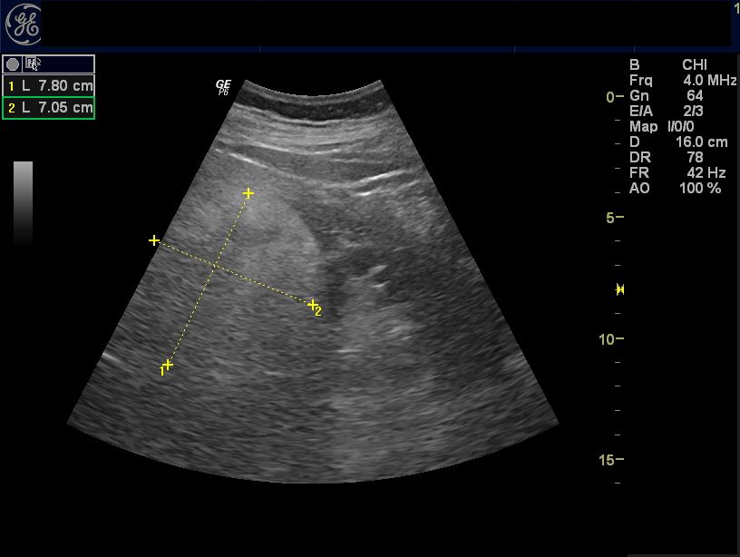 cochinblogs: Sonography of right renal mass: