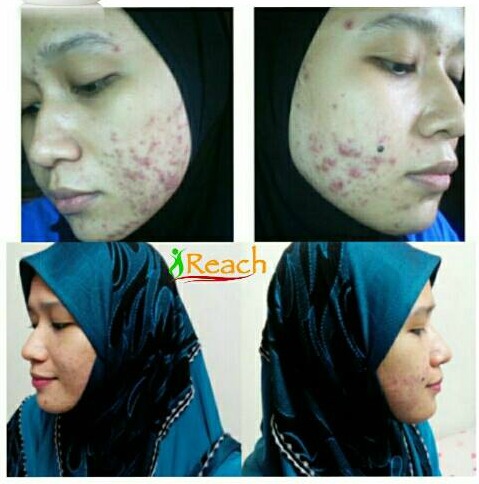 7 Punca Jerawat Dan Tindakan Yang Perlu Dilakukan - Healthy is a Lifestyle