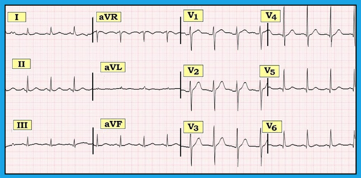 ECG Interpretation: ECG Blog #131 (Acute STEMI – Acute Occlusion of LAD ...