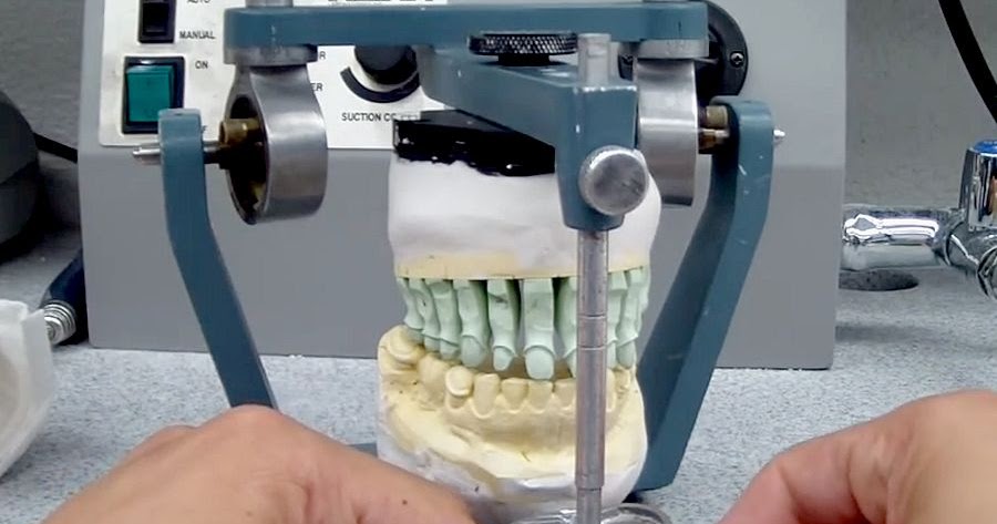 OCCLUSION: Custom Incisal Guide Table, What is this thing? (Video 1 ...