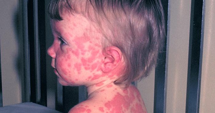 Sindrom Stevens Johnson