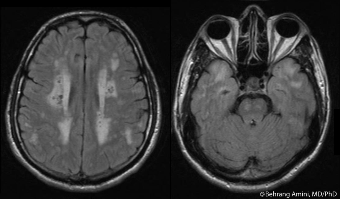 Roentgen Ray Reader: Cerebral autosomal dominant arteriopathy with ...